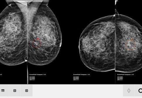 AI System Tries to Match Accuracy of 101 Radiologists on Mammograms ...